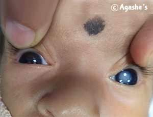 Paediatric Ophthalmology Results Gallery - Agashe Hospital
