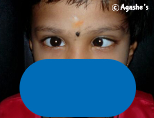 Paediatric Ophthalmology Results Gallery - Agashe Hospital