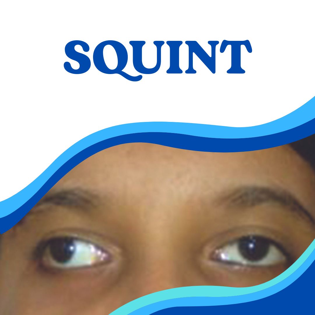 Squint - Agashe Hospital