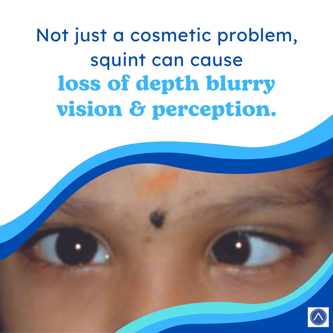 Squint - Agashe Hospital