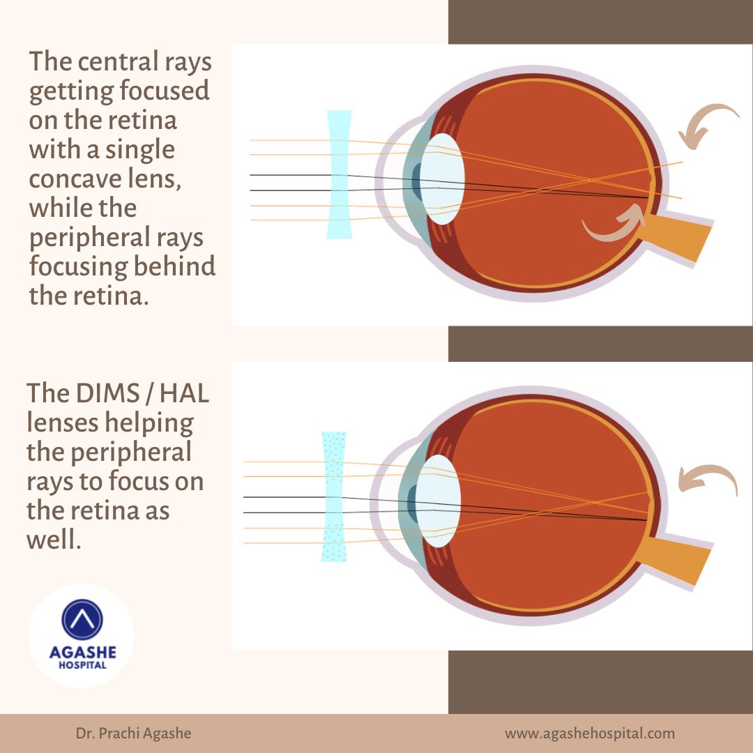 Technology to slow myopia progress in children